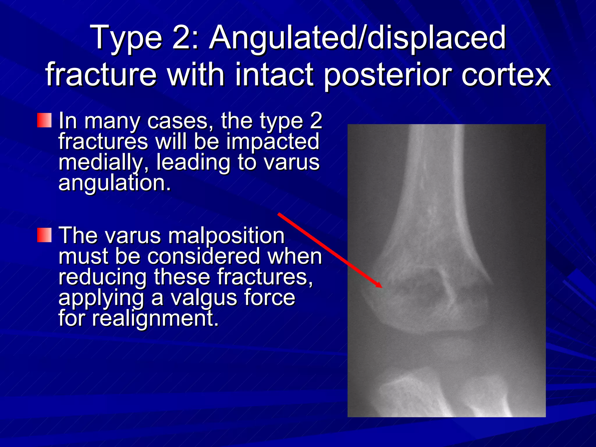 Supracondylar fractures in_children | PPT