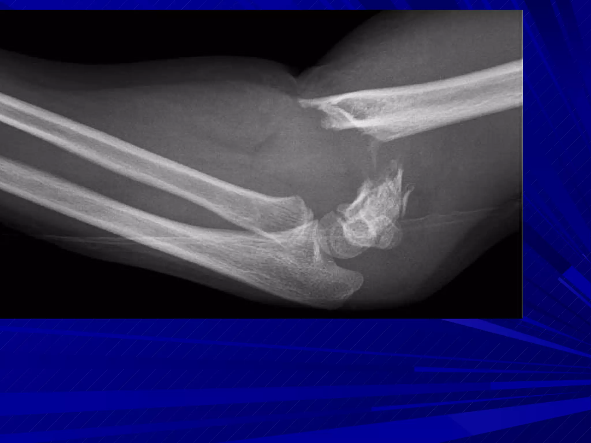 Supracondylar fractures in_children | PPT