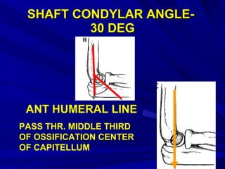 Supracondylar fractures in_children | PPT