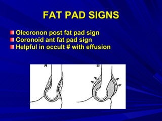 Supracondylar fractures in_children | PPT