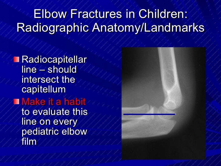 Supracondylar fractures in_children