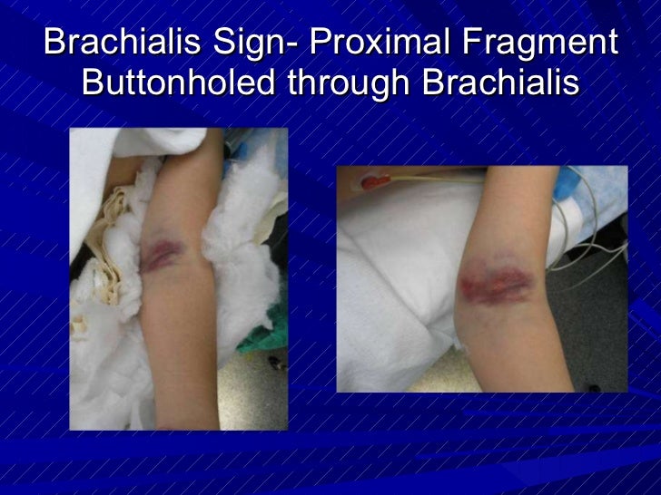 Supracondylar fractures in_children