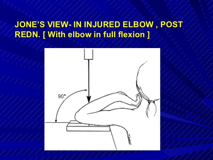 Supracondylar fractures in_children
