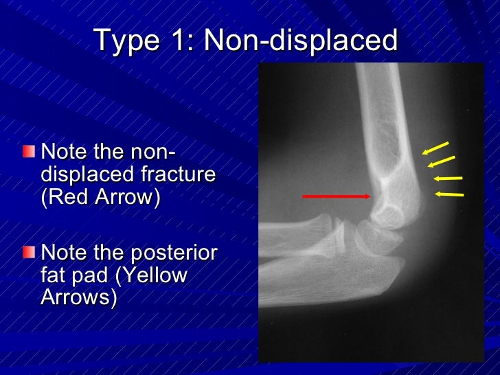 Supracondylar fractures in_children
