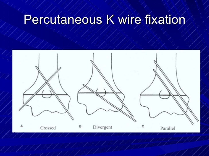 Supracondylar fractures in_children