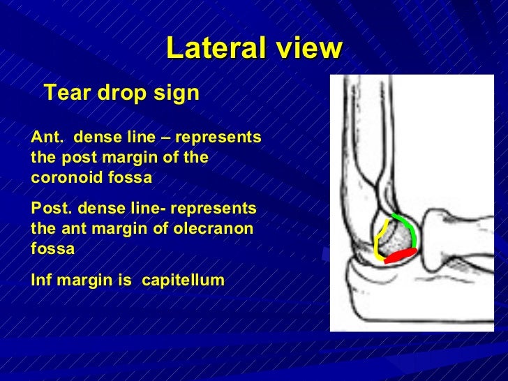 Supracondylar fractures in_children