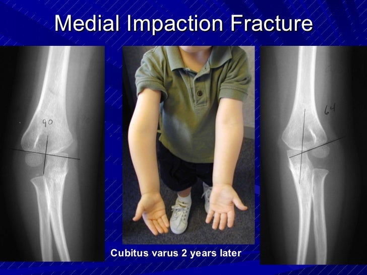 Supracondylar fractures in_children