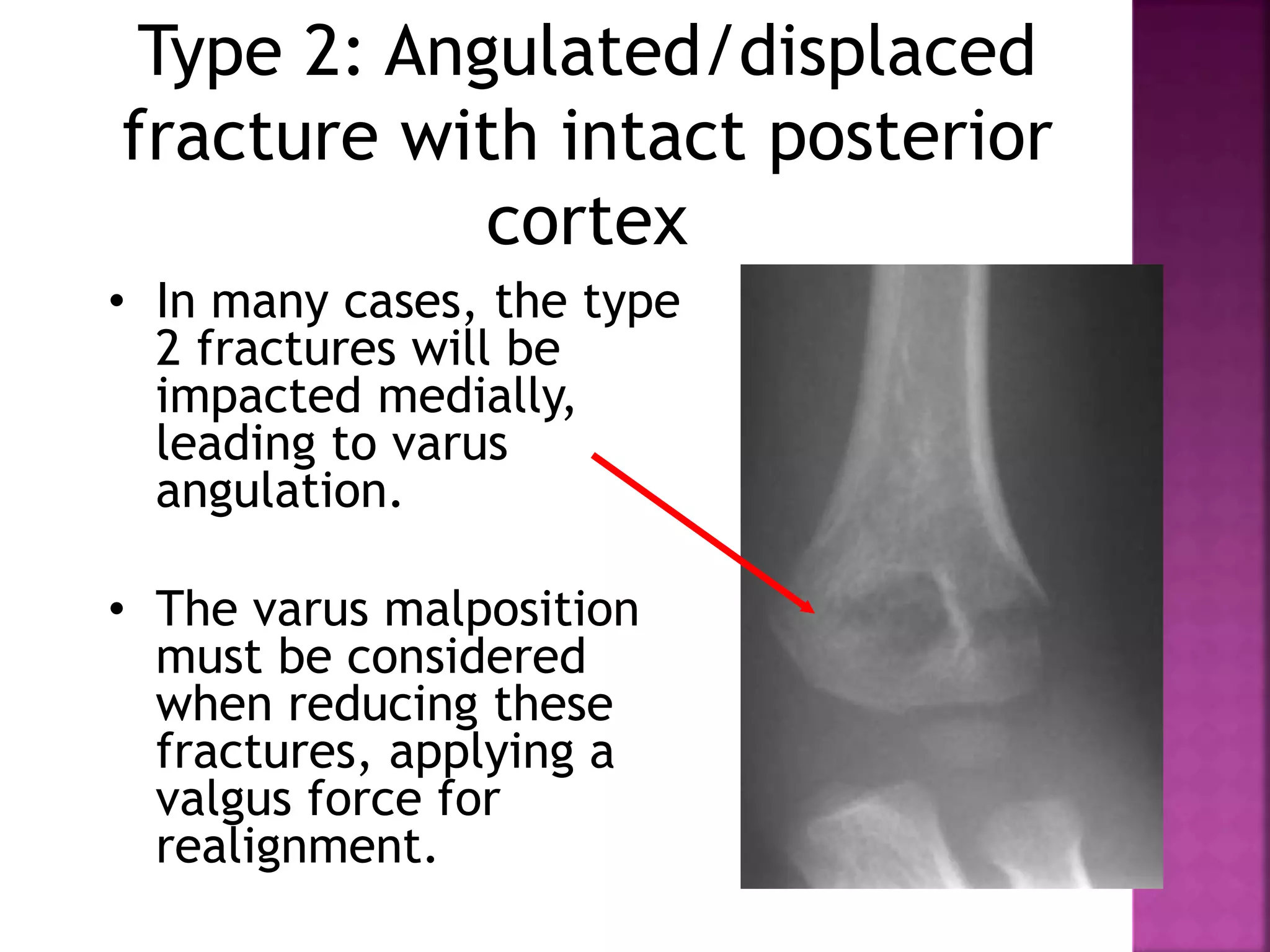 Supracondylar fractures in children | PPTX