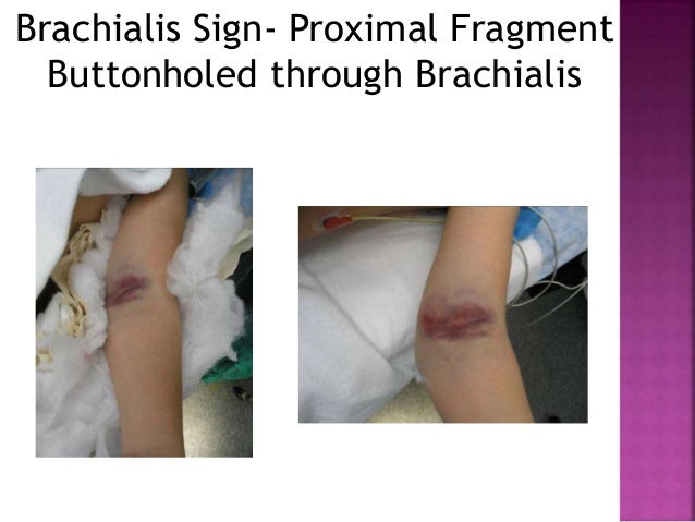 Supracondylar fractures in children