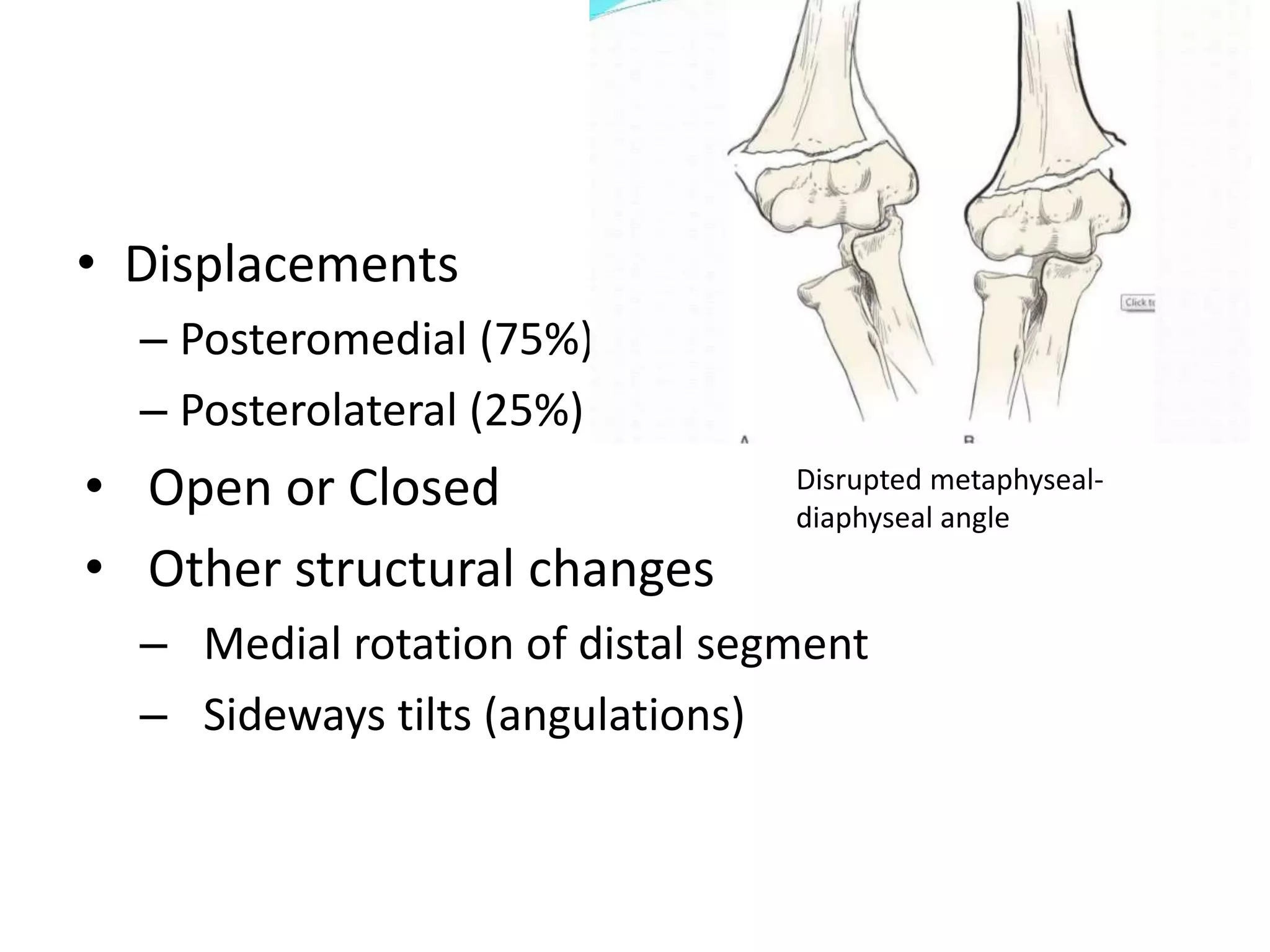 Supracondylar fractures in children | PPTX
