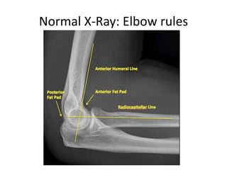Supracondylar fractures in children | PPTX