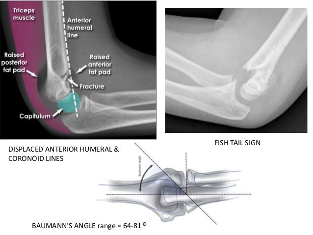 Supracondylar fractures in children