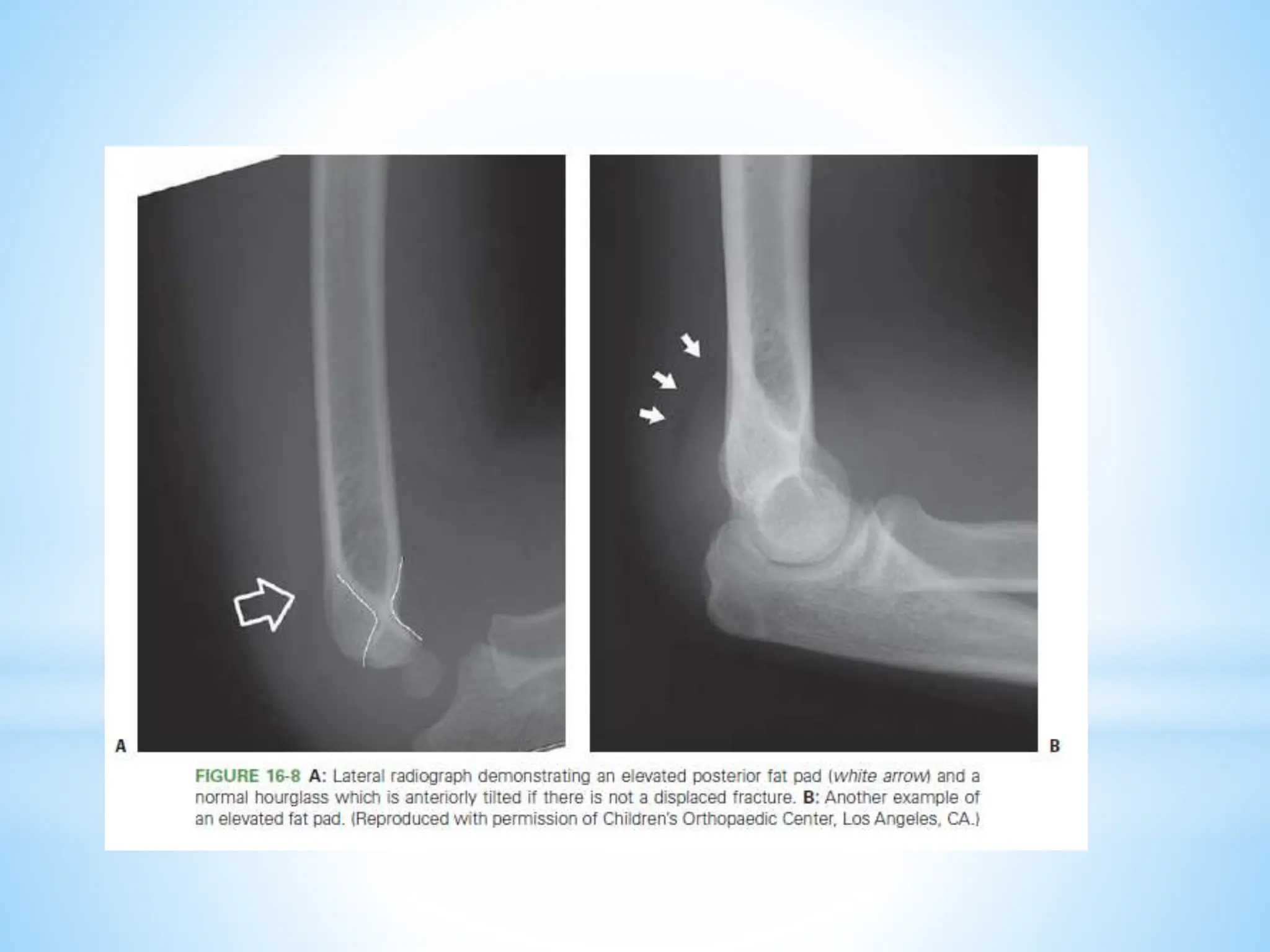 supracondylar fractures in children.pptx