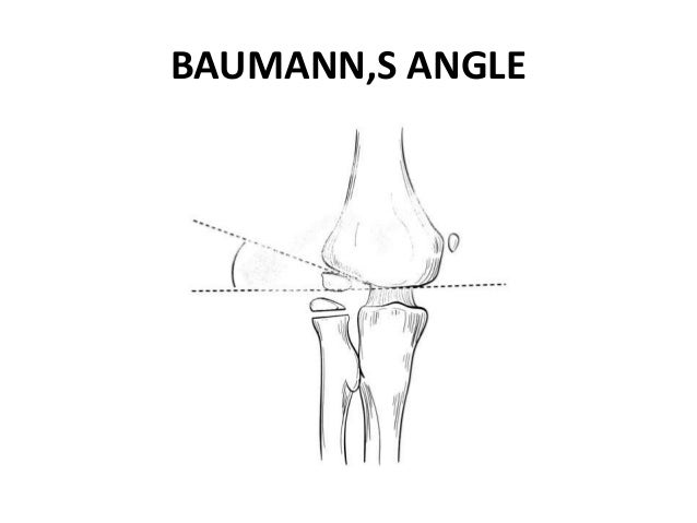 Supracondylar fracture humerus - visualmoli
