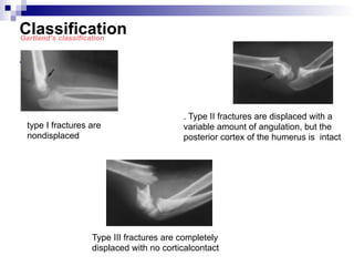 Supracondylar Fractures of the Humerus in Children-2.pdf