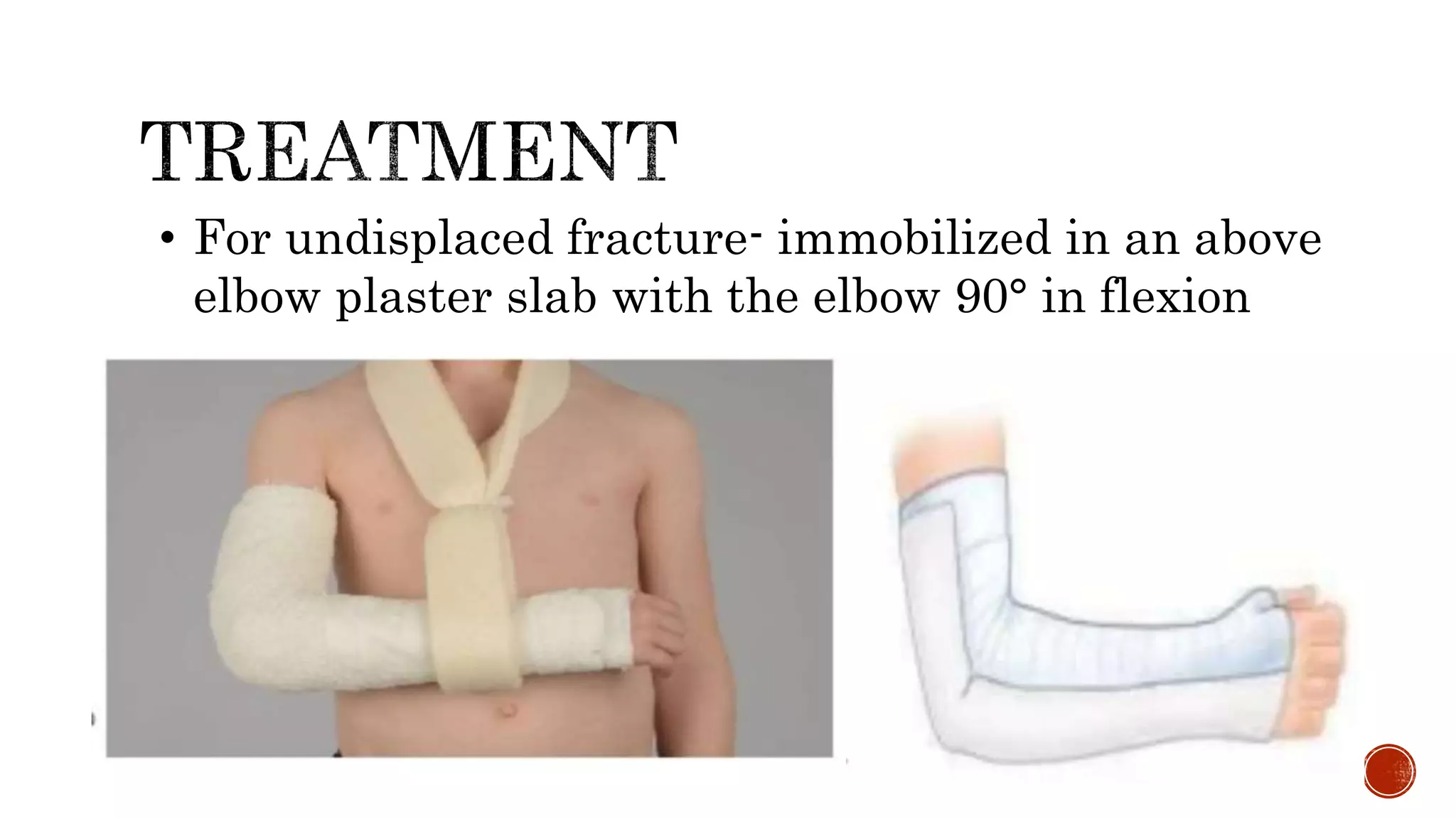 supracondylar fracture treatment and complications.pptx