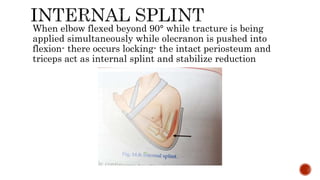 supracondylar fracture treatment and complications.pptx