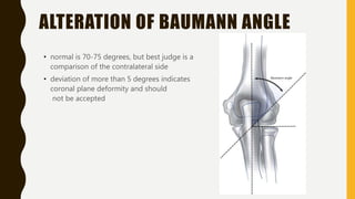 Supracondylar fx | PPT
