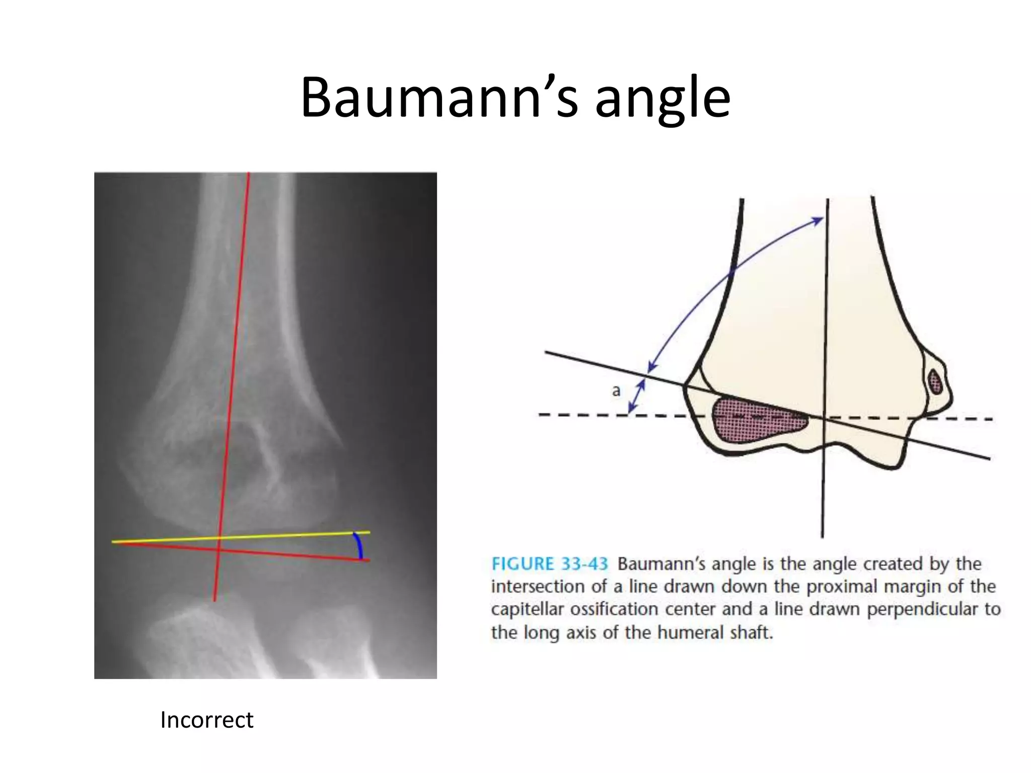 Supracondylar humeral fracture | PPTX