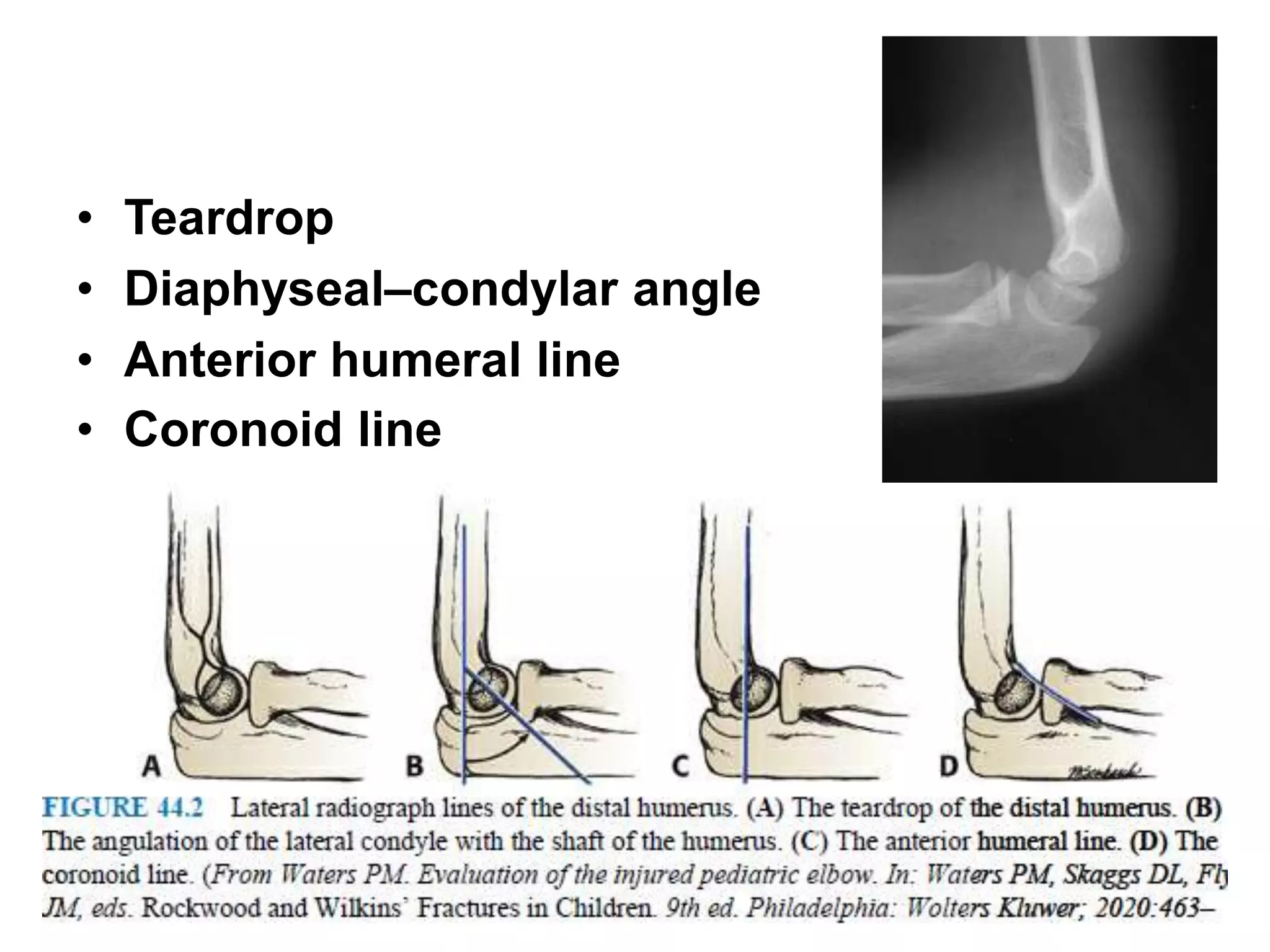 Supracondylar humeral fracture | PPTX