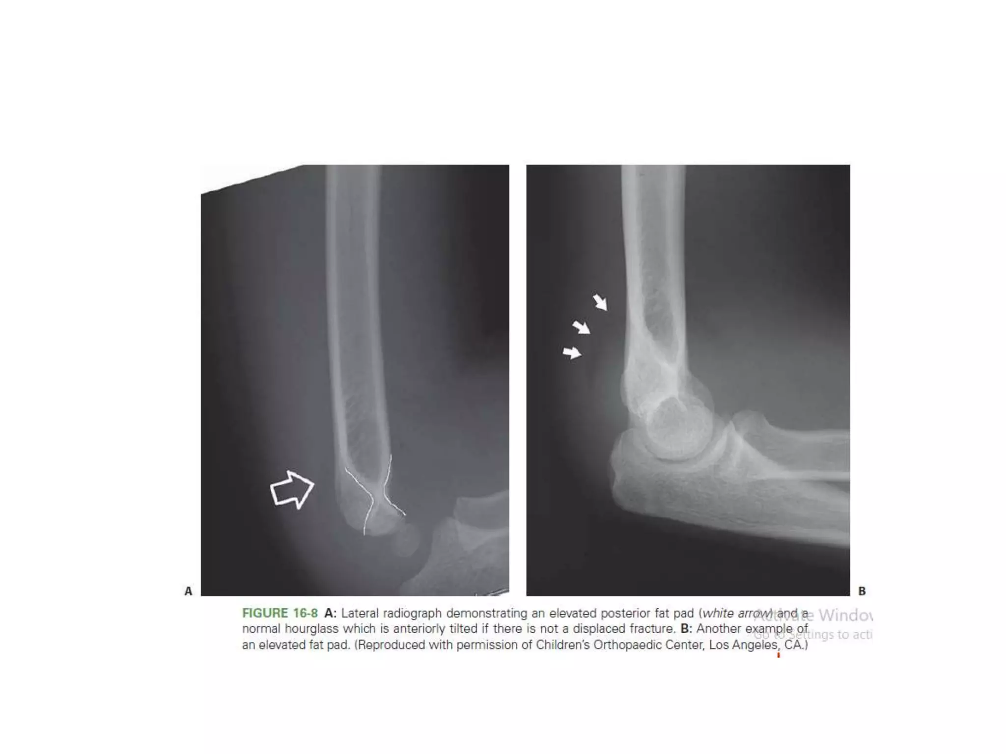 Supracondylar humeral fracture | PPTX