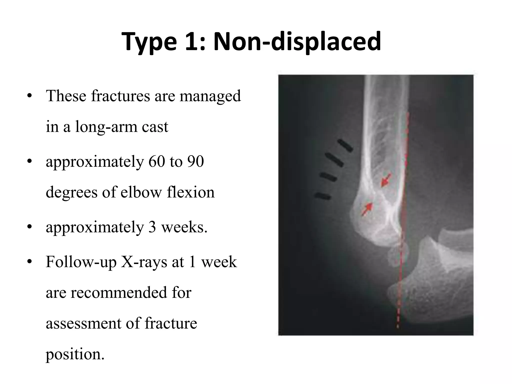 Supracondylar humeral fracture | PPTX