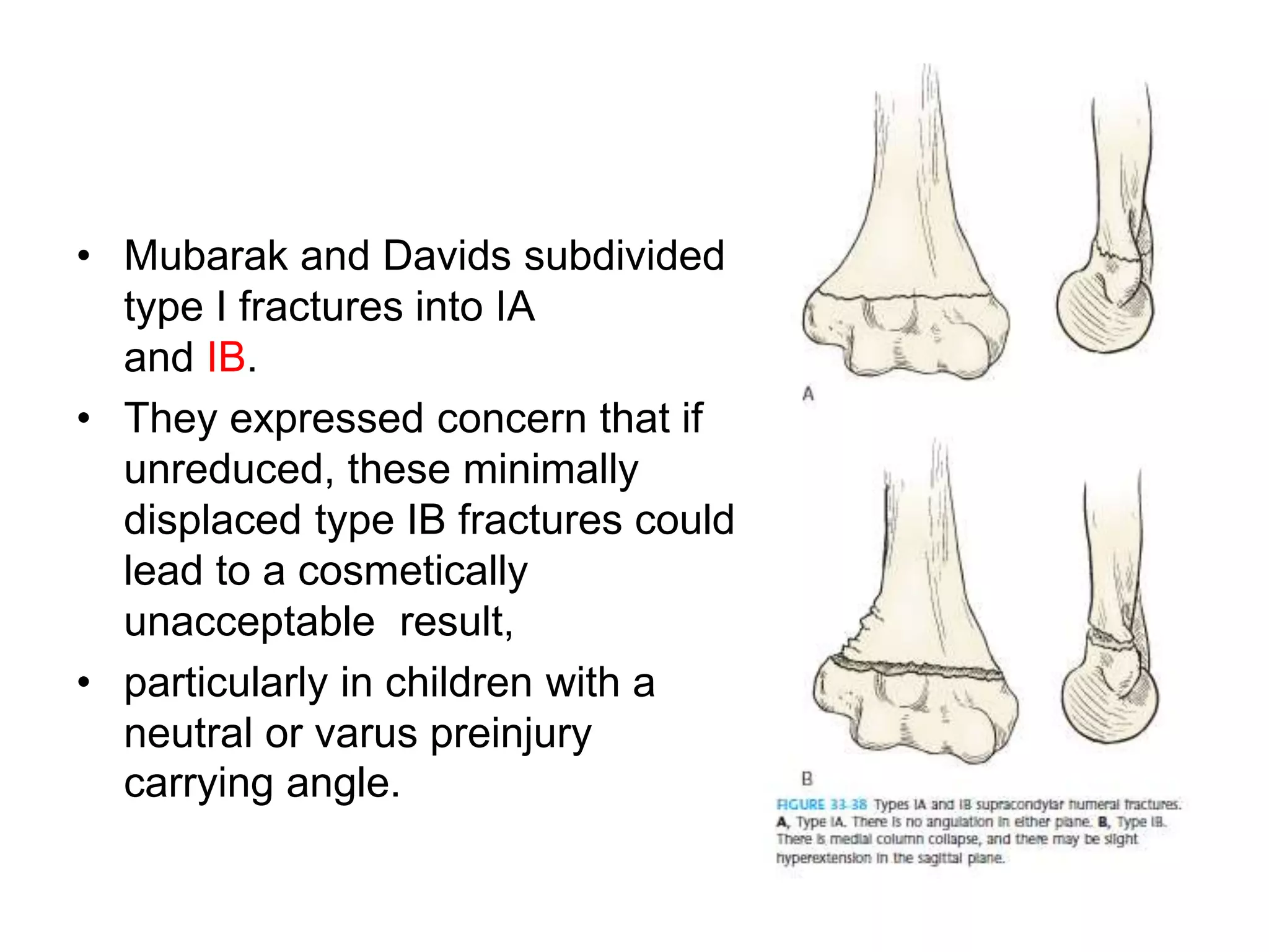 Supracondylar humeral fracture | PPTX
