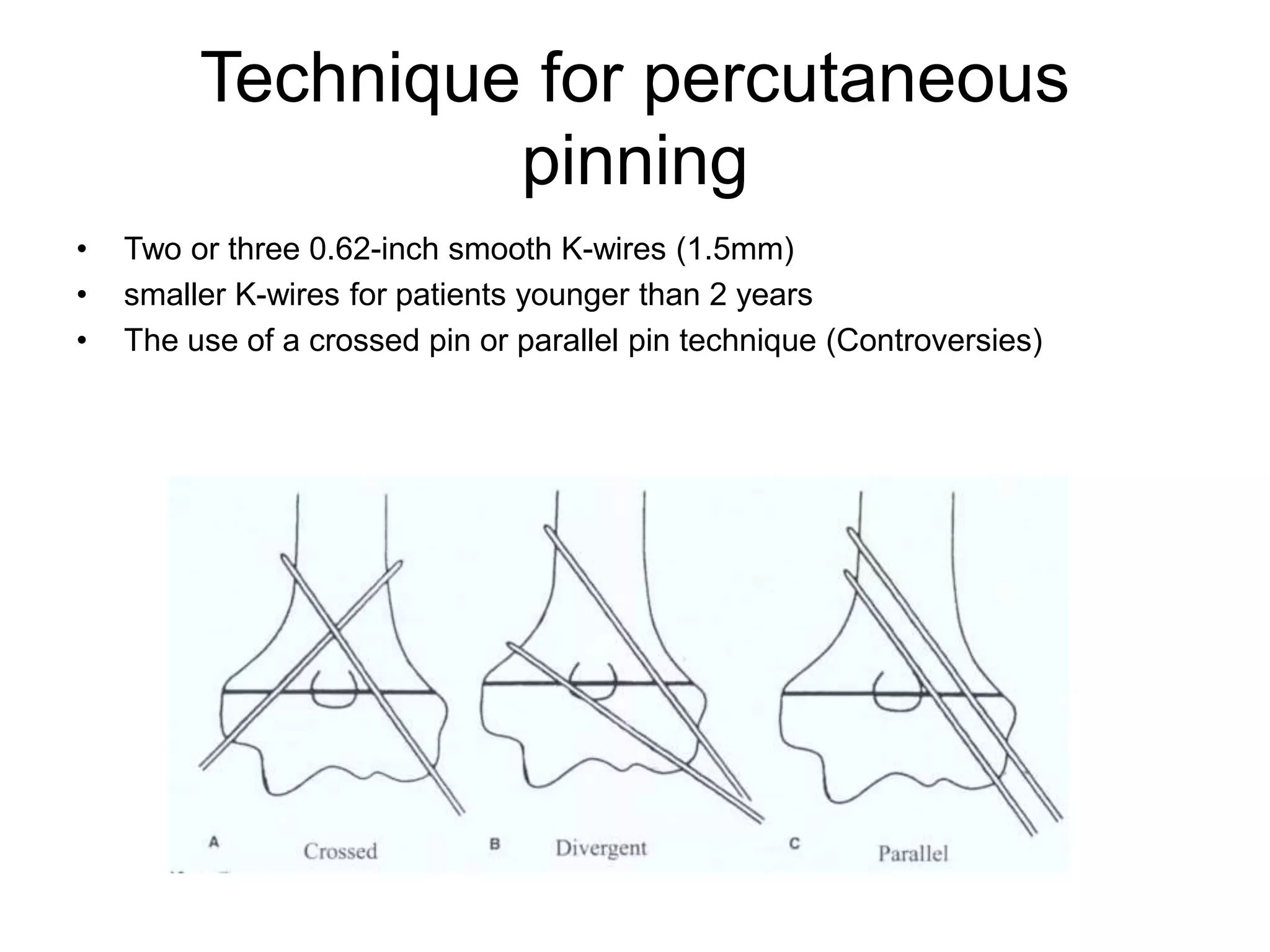 Supracondylar humeral fracture | PPTX