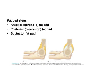 Supracondylar humeral fracture | PPTX
