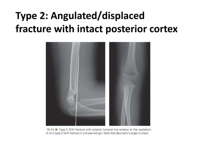 Supracondylar humeral fracture | PPTX
