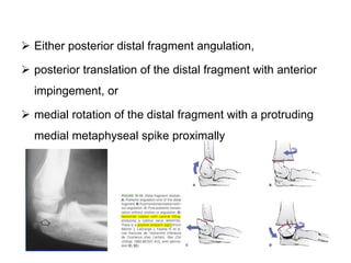 Supracondylar humeral fracture | PPTX