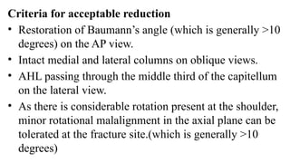 supracondylar humerus fractures (1).pptx