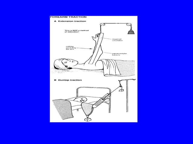 Supracondylar humerus and pink pulseless extremity | PPT
