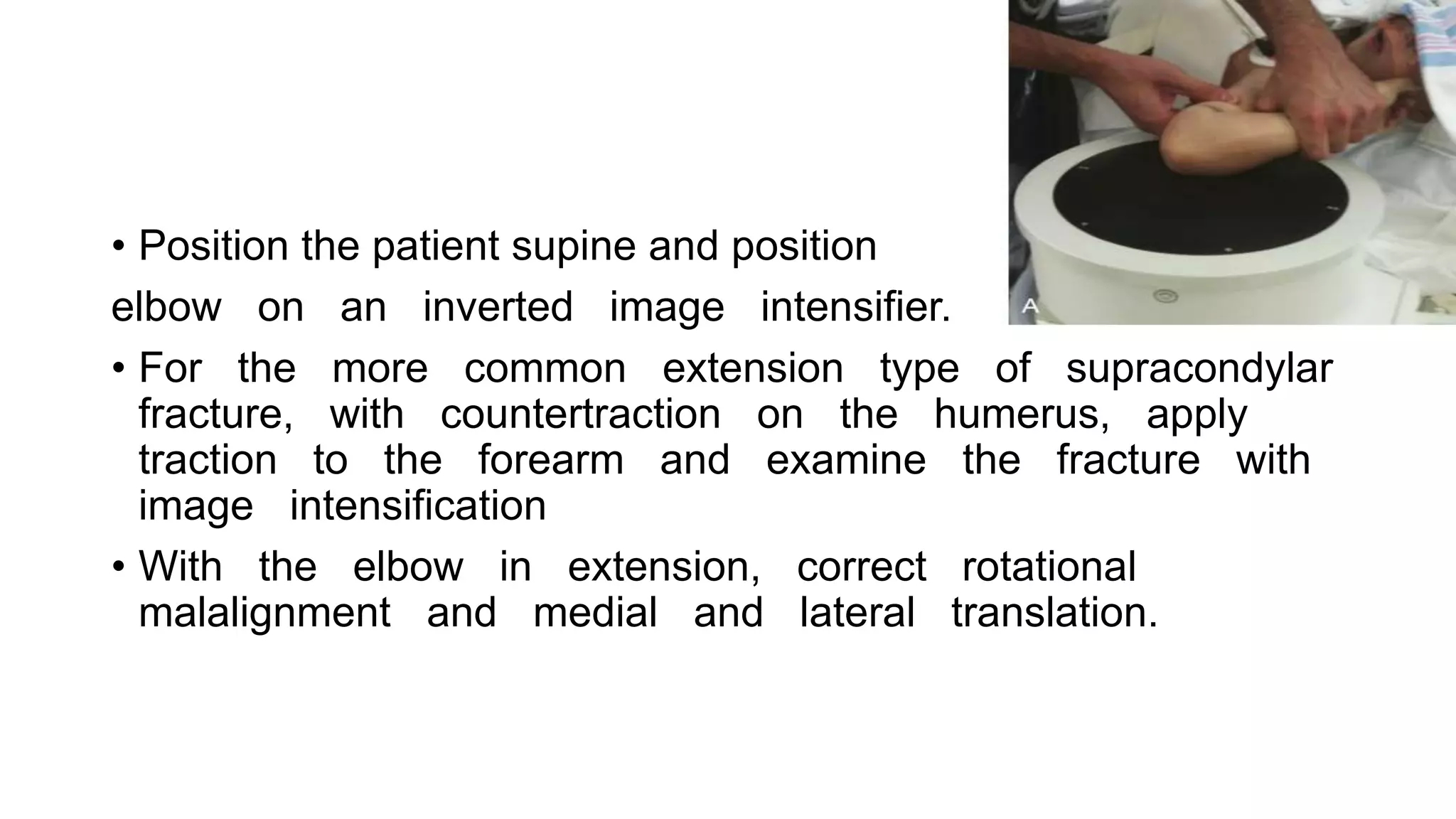 Supracondylar humerus fracture percutaneous pinning video demo | PPTX ...