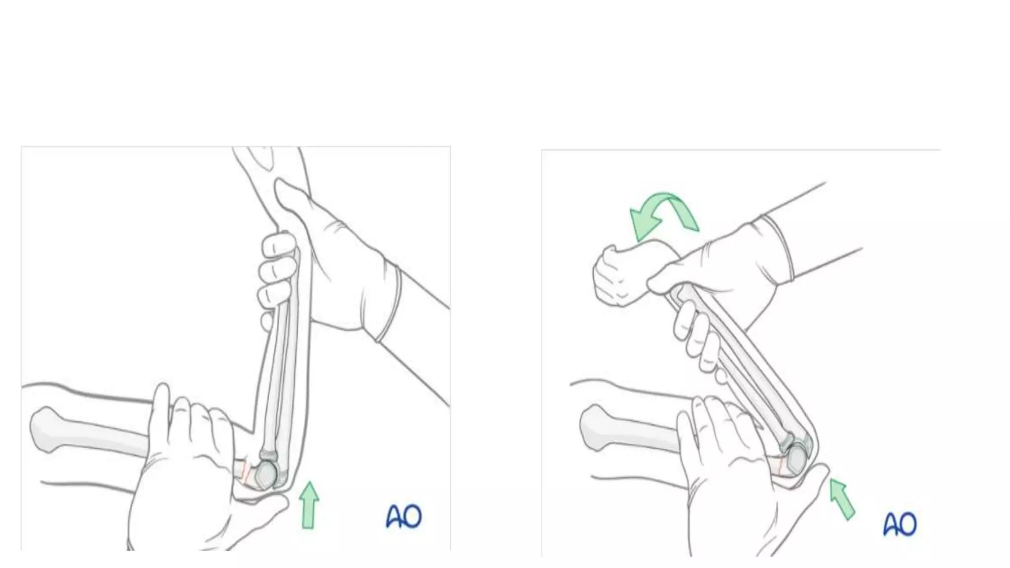 Supracondylar humerus fracture percutaneous pinning video demo | PPTX ...