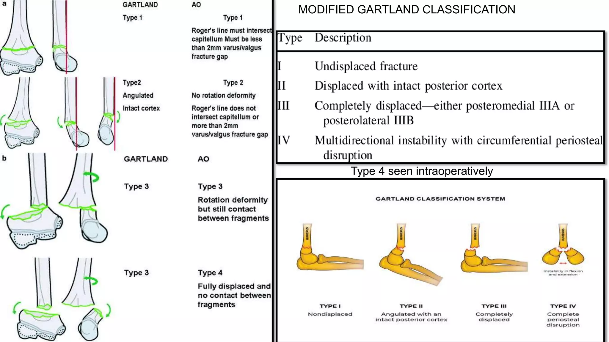 Supracondylar humerus fracture percutaneous pinning video demo | PPTX ...