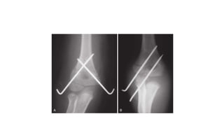 Supracondylar humerus fracture percutaneous pinning video demo | PPT