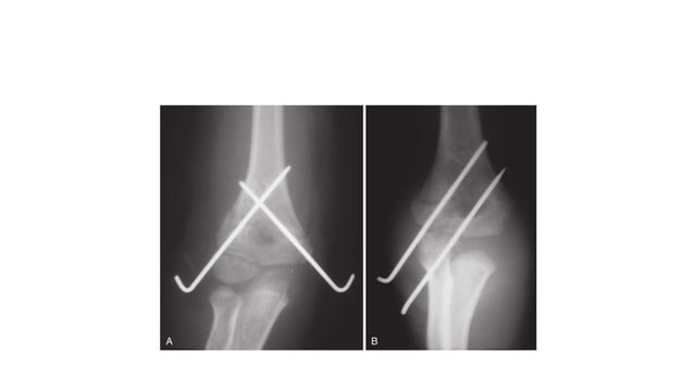 Supracondylar humerus fracture percutaneous pinning video demo | PPTX ...