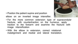 Supracondylar humerus fracture percutaneous pinning video demo | PPTX