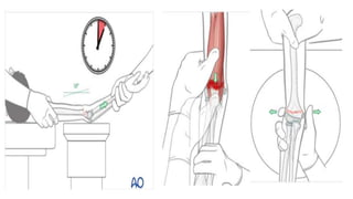 Supracondylar humerus fracture percutaneous pinning video demo | PPT