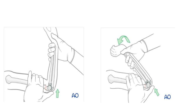 Supracondylar humerus fracture percutaneous pinning video demo | PPTX ...