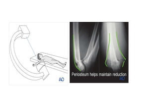 Supracondylar humerus fracture percutaneous pinning video demo | PPTX