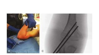 Supracondylar humerus fracture percutaneous pinning video demo | PPT