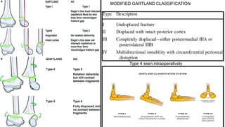 Supracondylar humerus fracture percutaneous pinning video demo | PPT