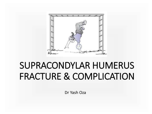 Fracture Humérus Complication – Fracture De Humérus Anatomie – ARKBC