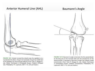 Supracondylar humerus fracture & complication for MBBS students | PPTX