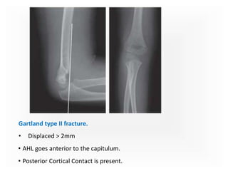 Supracondylar humerus fracture & complication for MBBS students | PPTX