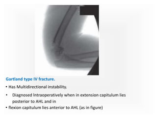 Supracondylar humerus fracture & complication for MBBS students | PPTX