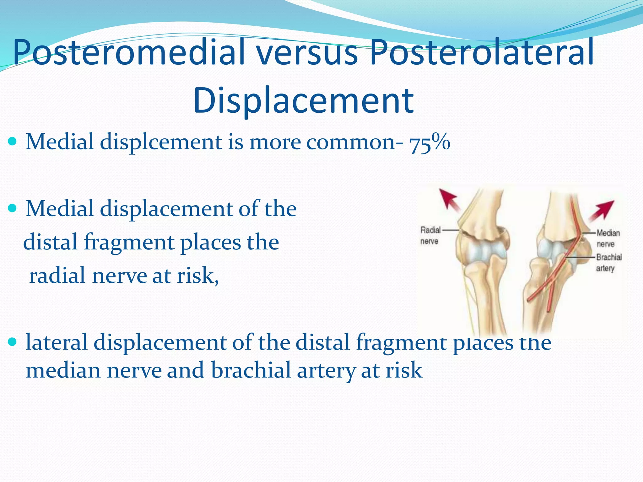 Supra condylar humerus fracture in children | PPTX