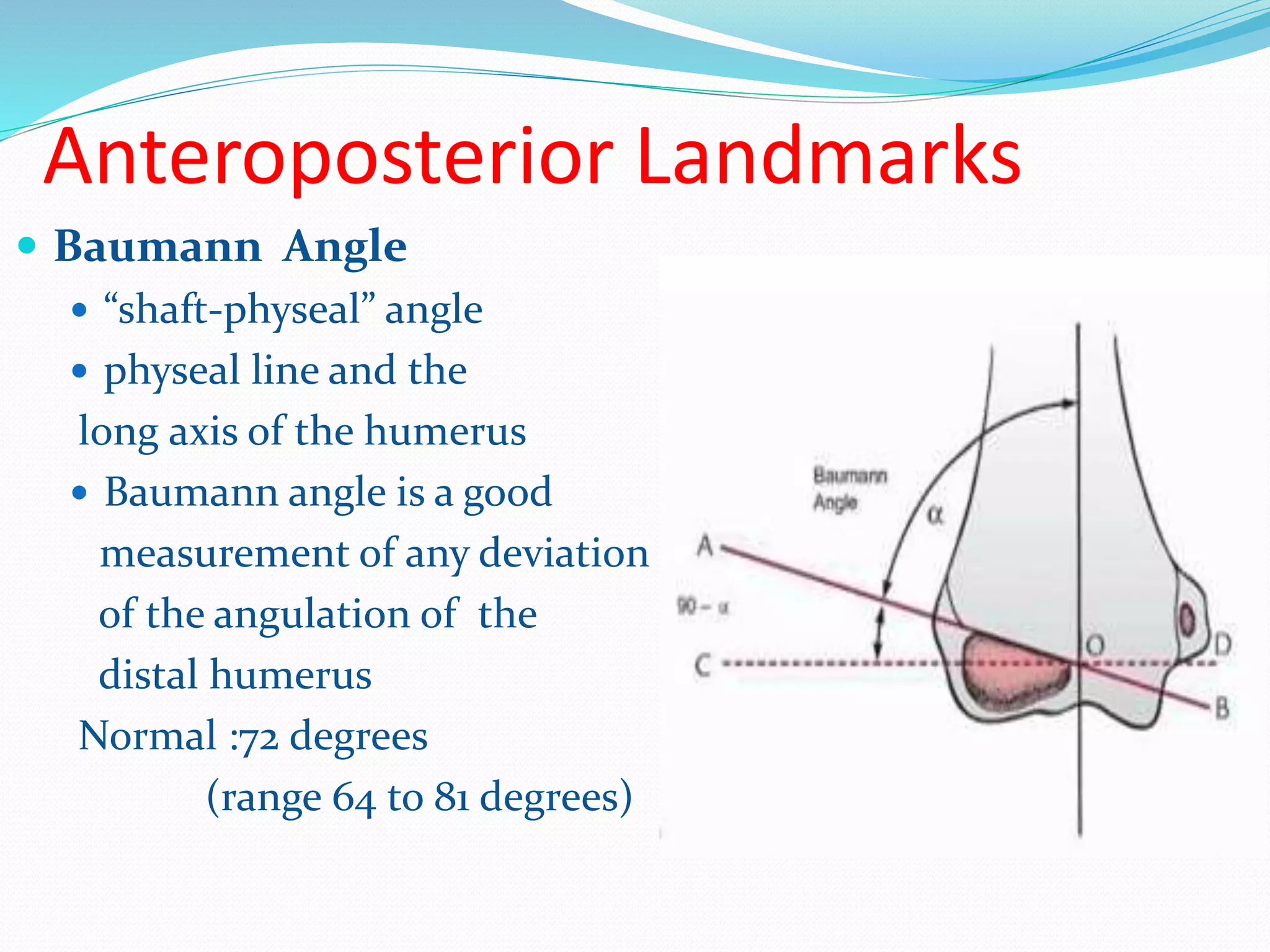 Supra condylar humerus fracture in children | PPTX